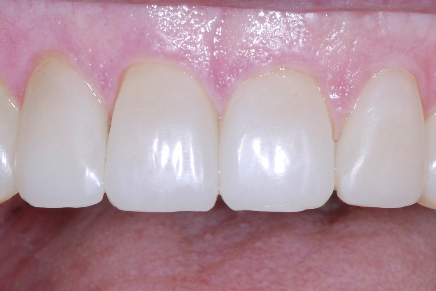 The next generation of the composite veneering system